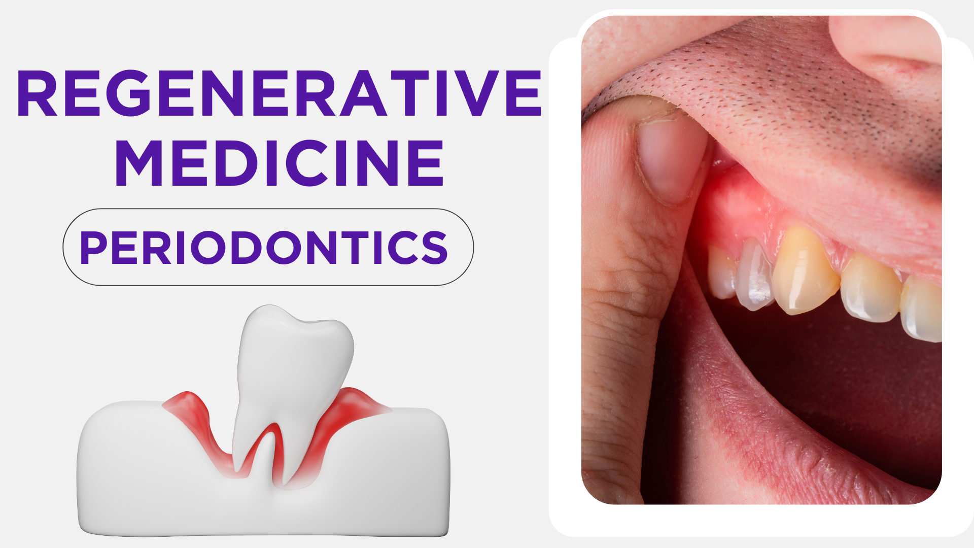 Regenerative Medicine in Periodontics: Advances in Tissue Repair and ...